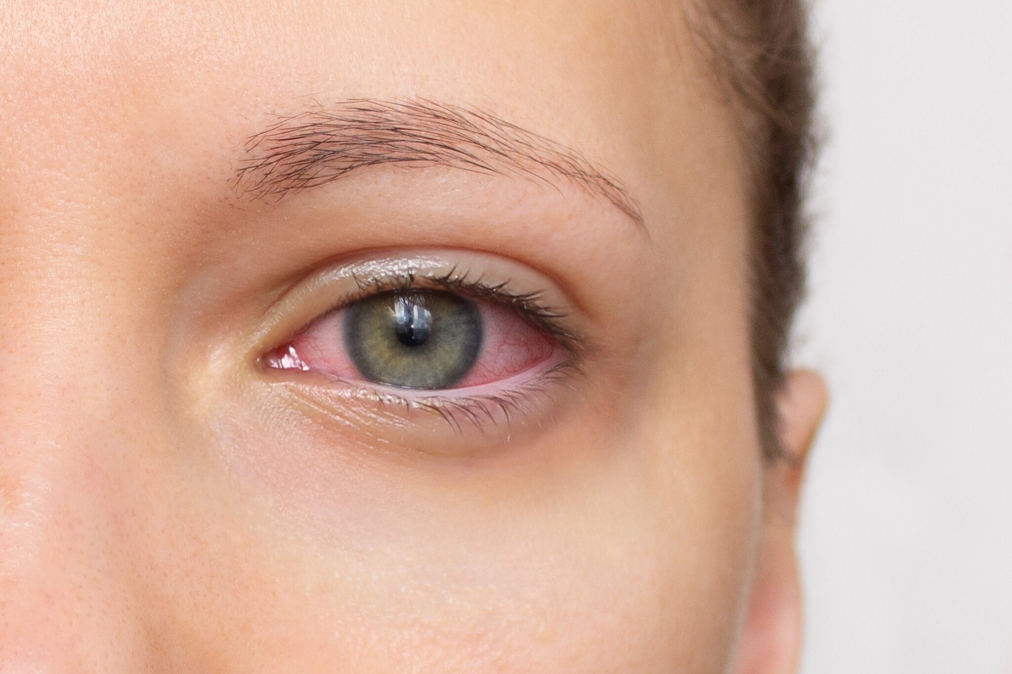 Why Are My Eyes Red? Common Causes Beyond Pink Eye | Tennessee Eye Care
