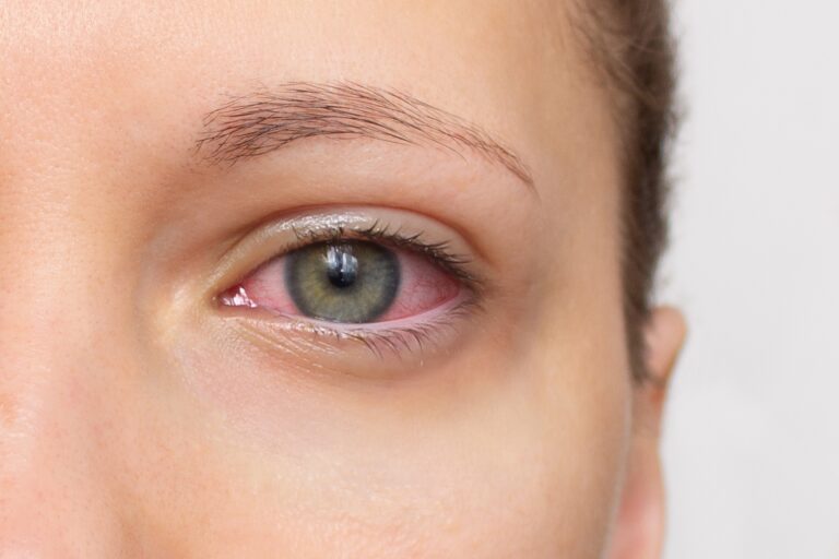 Why Are My Eyes Red? Common Causes Beyond Pink Eye | Tennessee Eye Care